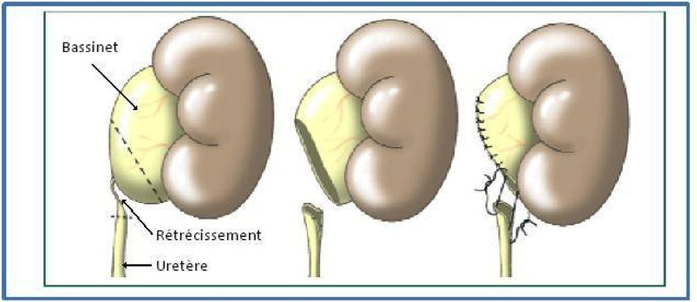 Groupe Urologie : Pyéloplastie (cure de jonction pyélo-urétérale)